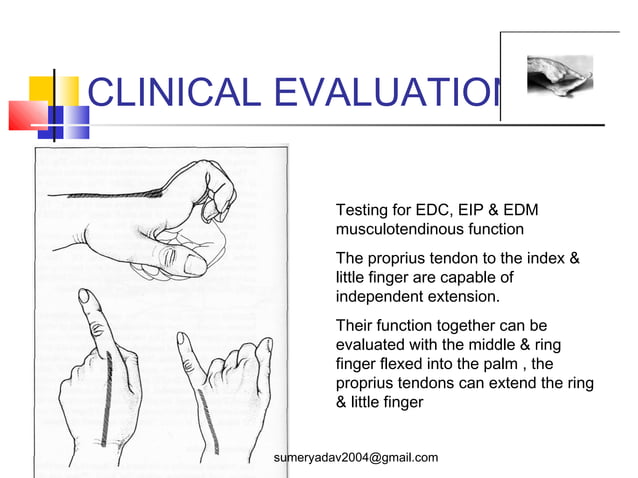 extensor tendons injury and deformity | PPT