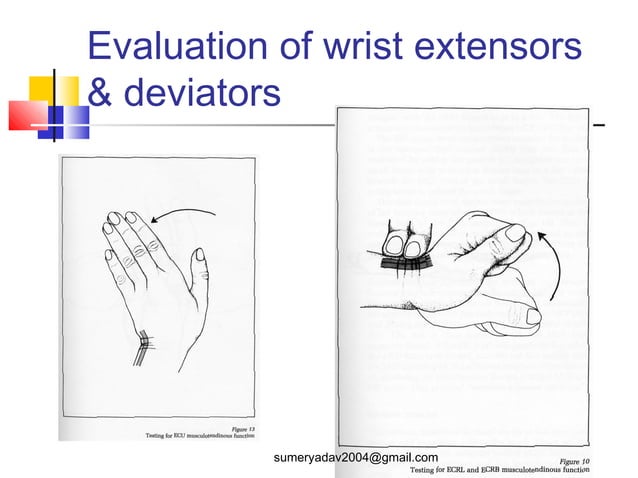 extensor tendons injury and deformity | PPT