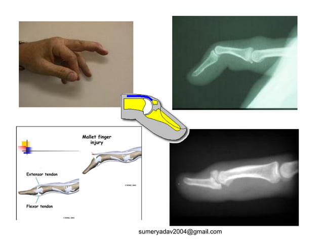 extensor tendons injury and deformity | PPT