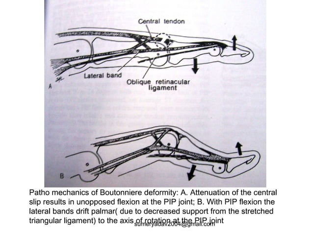 extensor tendons injury and deformity | PPT