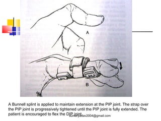 extensor tendons injury and deformity | PPT