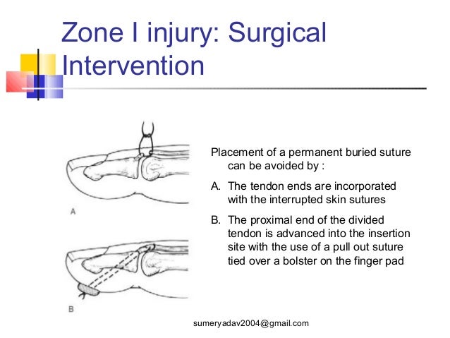 extensor tendons injury and deformity