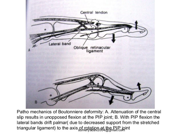 extensor tendons injury and deformity