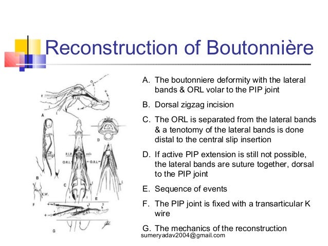 extensor tendons injury and deformity