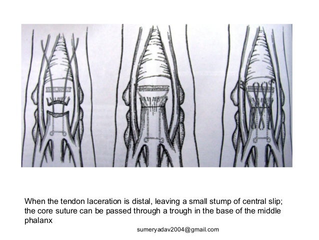extensor tendons injury and deformity