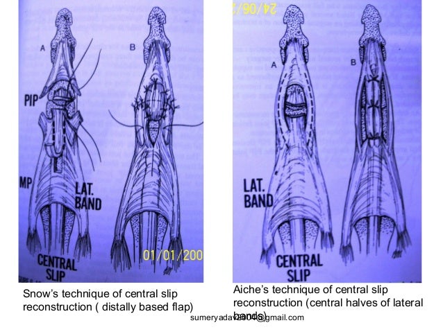 extensor tendons injury and deformity