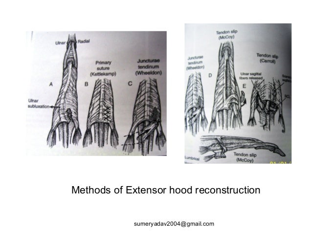 extensor tendons injury and deformity