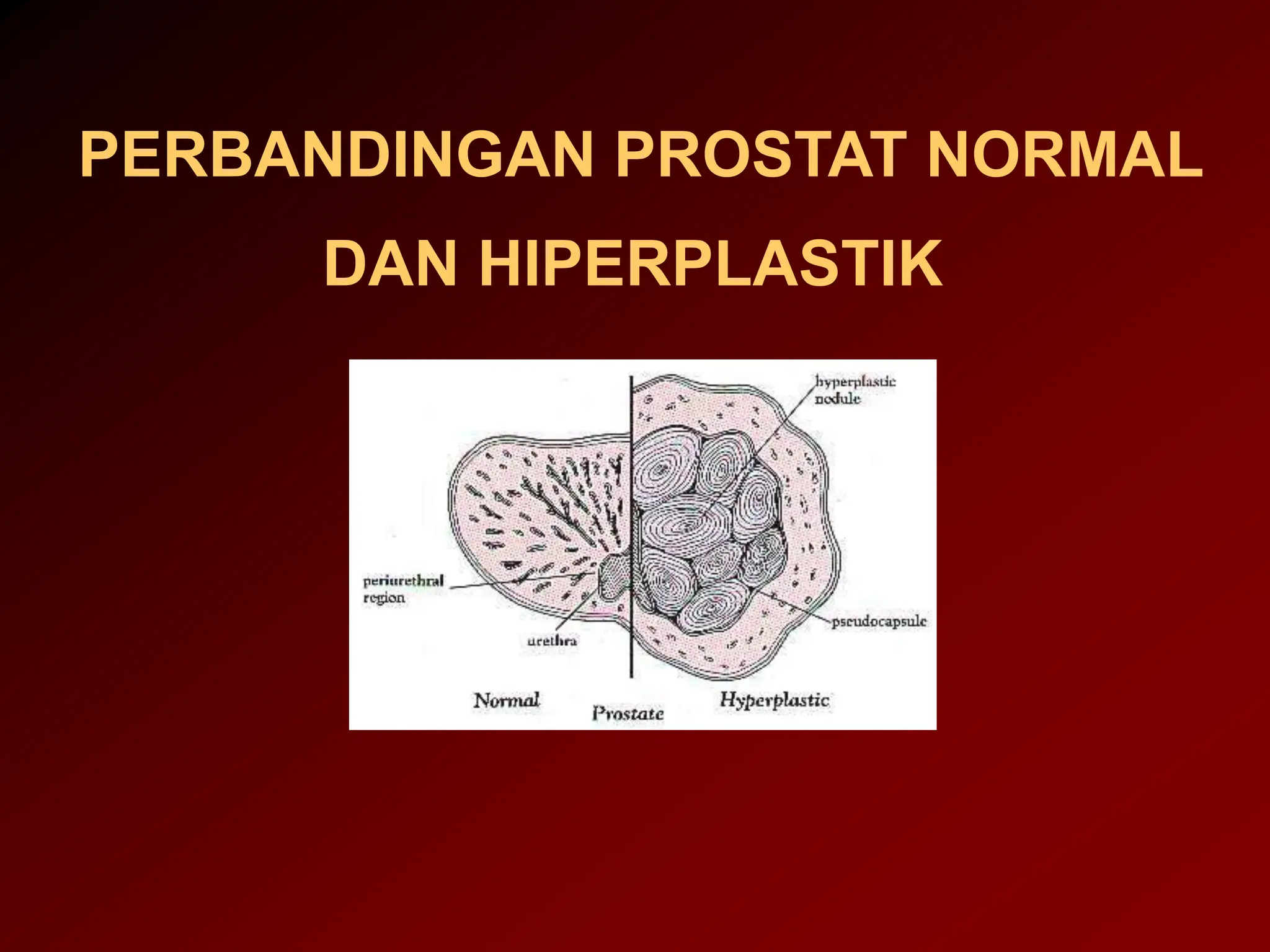 Benign Prostate Hipertrophy (BPH) .ppt
