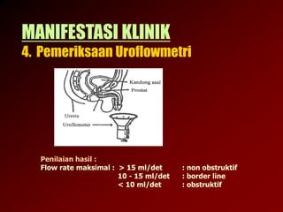 Benign Prostate Hipertrophy (BPH) .ppt