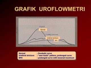 Benign Prostate Hipertrophy (BPH) .ppt