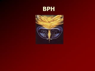 Benign Prostate Hipertrophy Bph Ppt