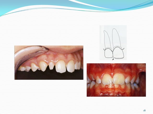 138324 diagnosis-an-orthodontic-case | PDF | Dental Health | Diseases ...