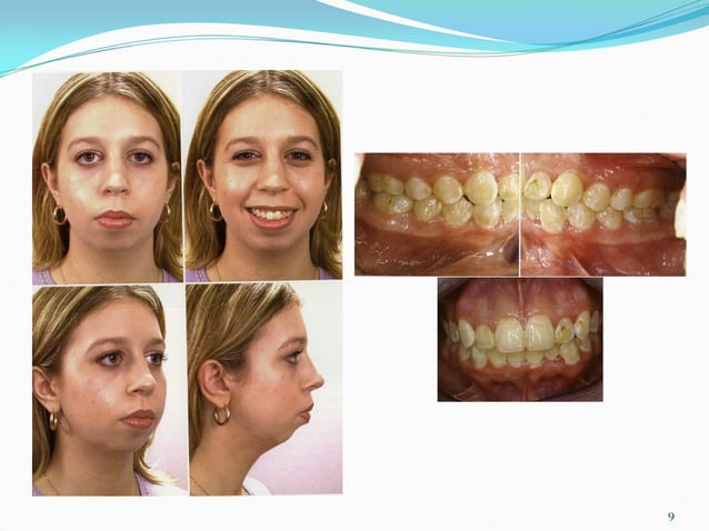 138324 diagnosis-an-orthodontic-case | PDF | Dental Health | Diseases ...