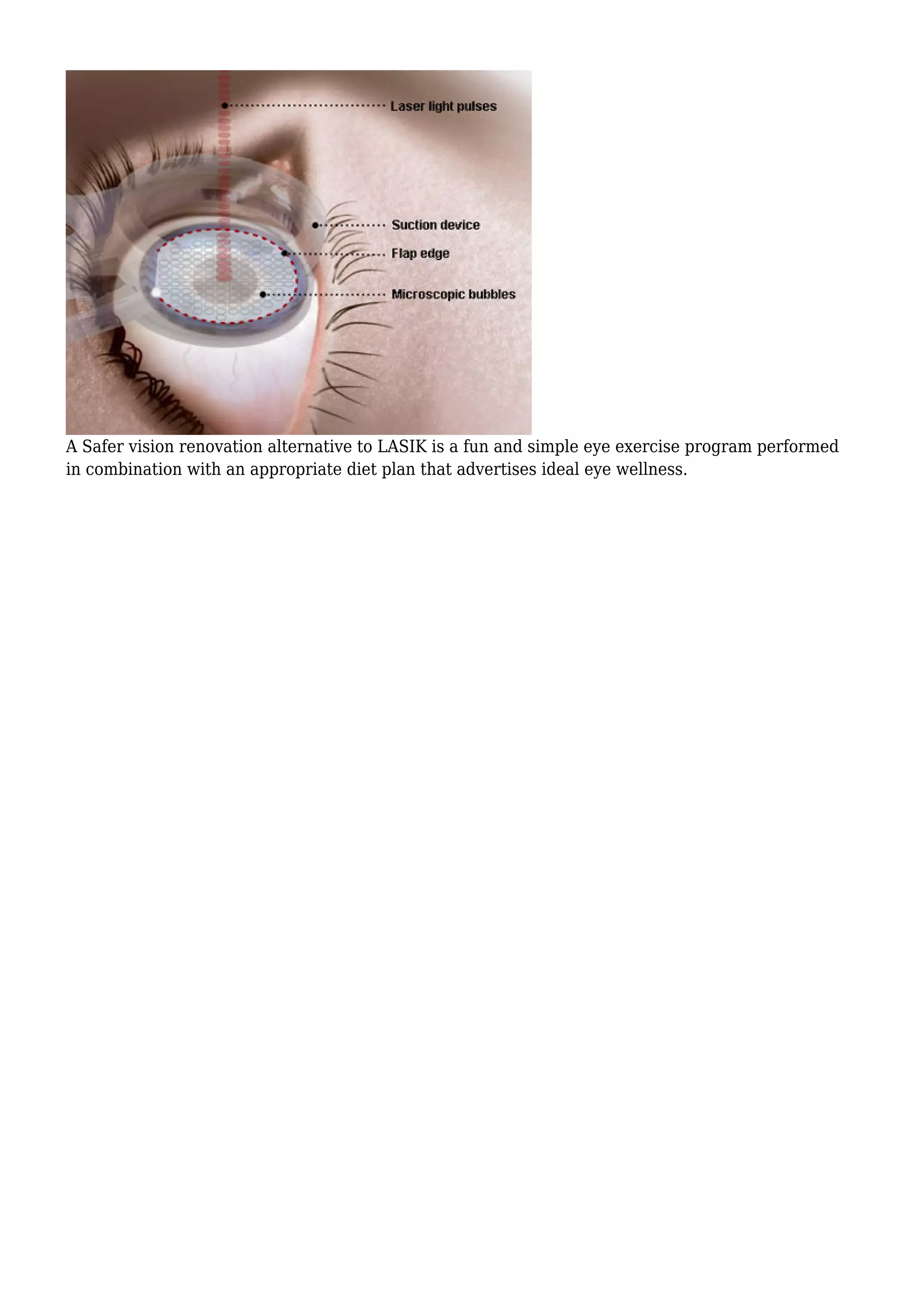 An Assessment Of The Advantages and disadvantages Of LASIK Surgery | PDF