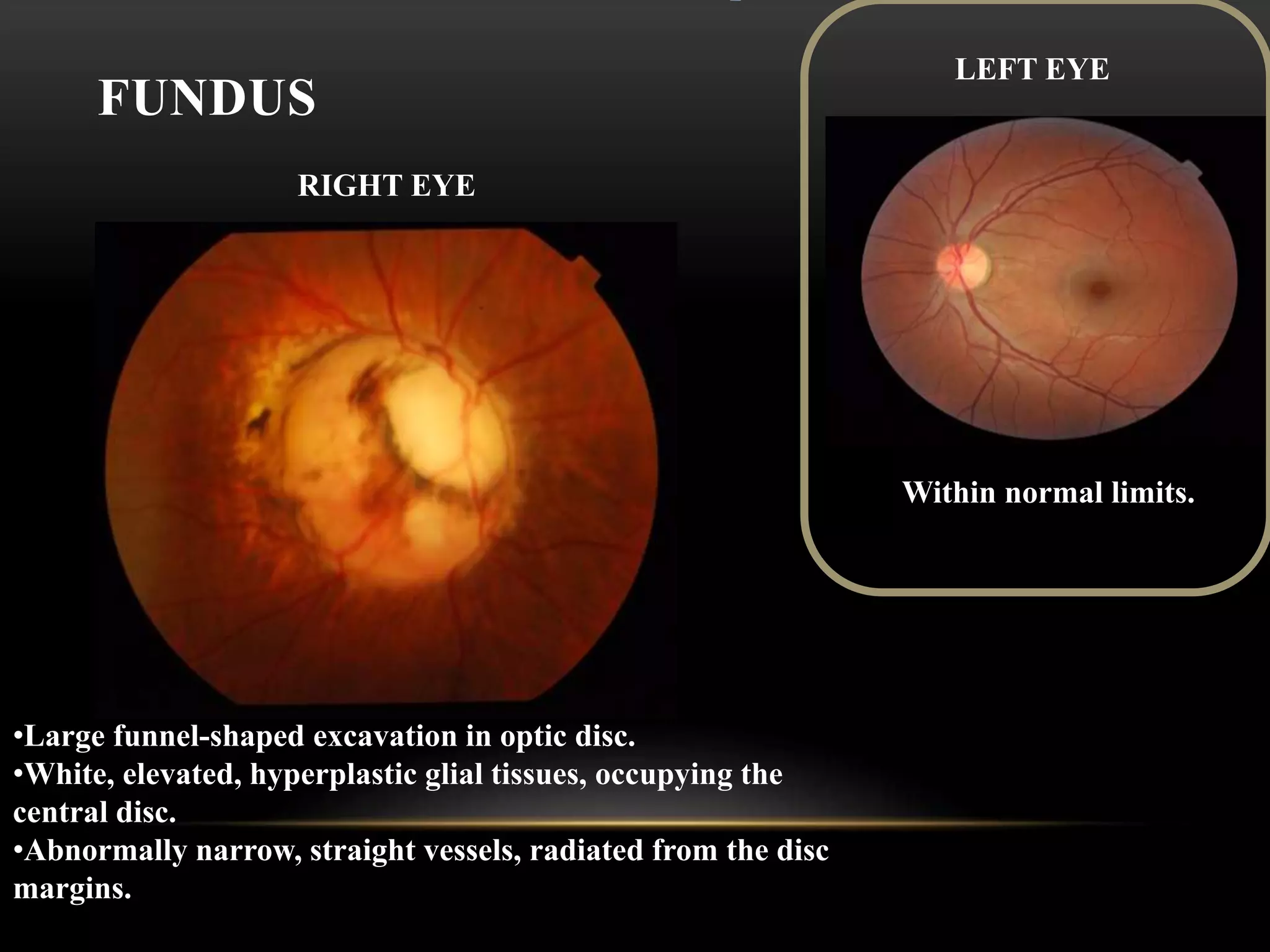 Unilateral Disc Anomaly: Morning Glory Syndrome | PPTX