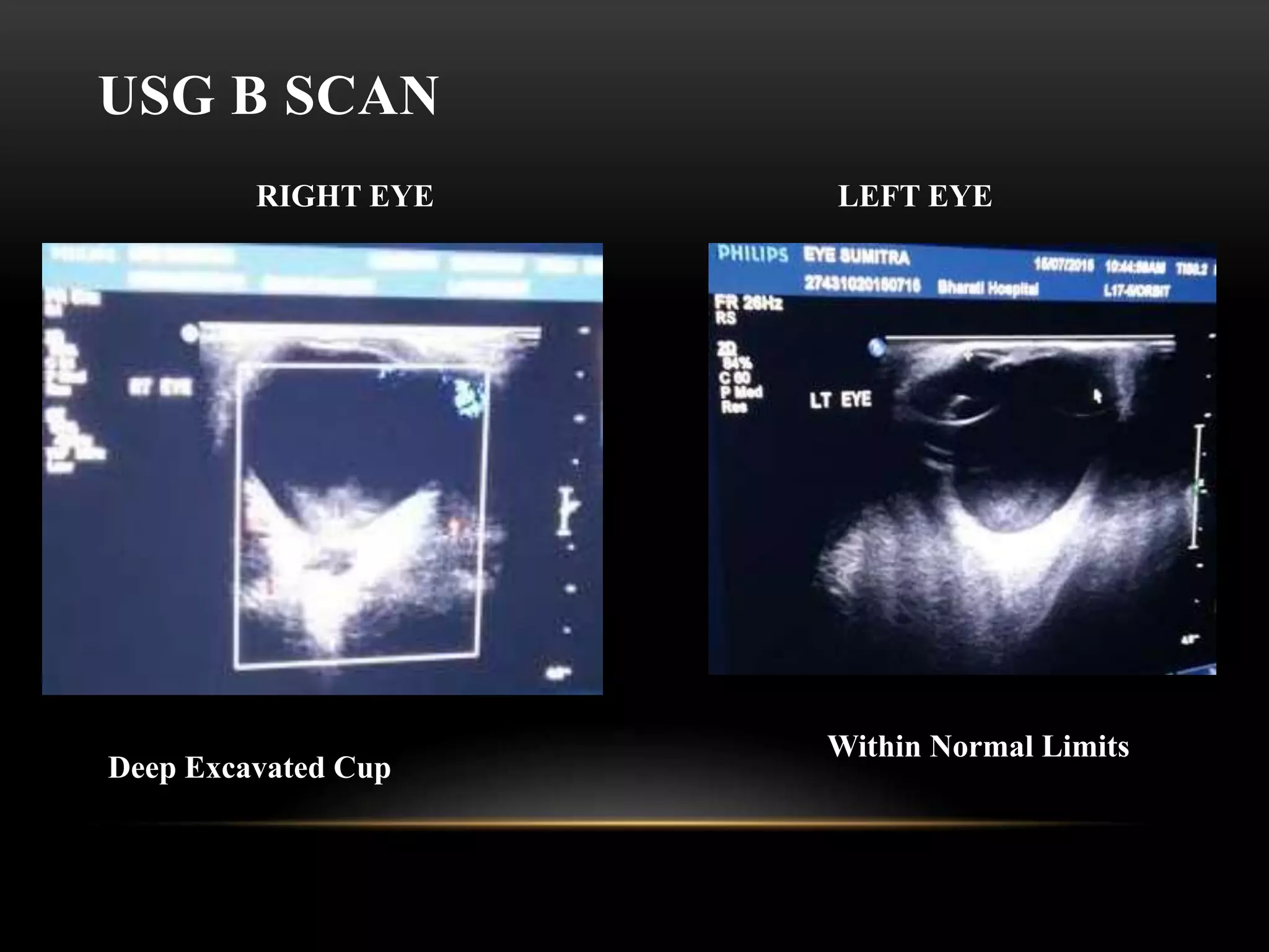 Unilateral Disc Anomaly: Morning Glory Syndrome | PPTX