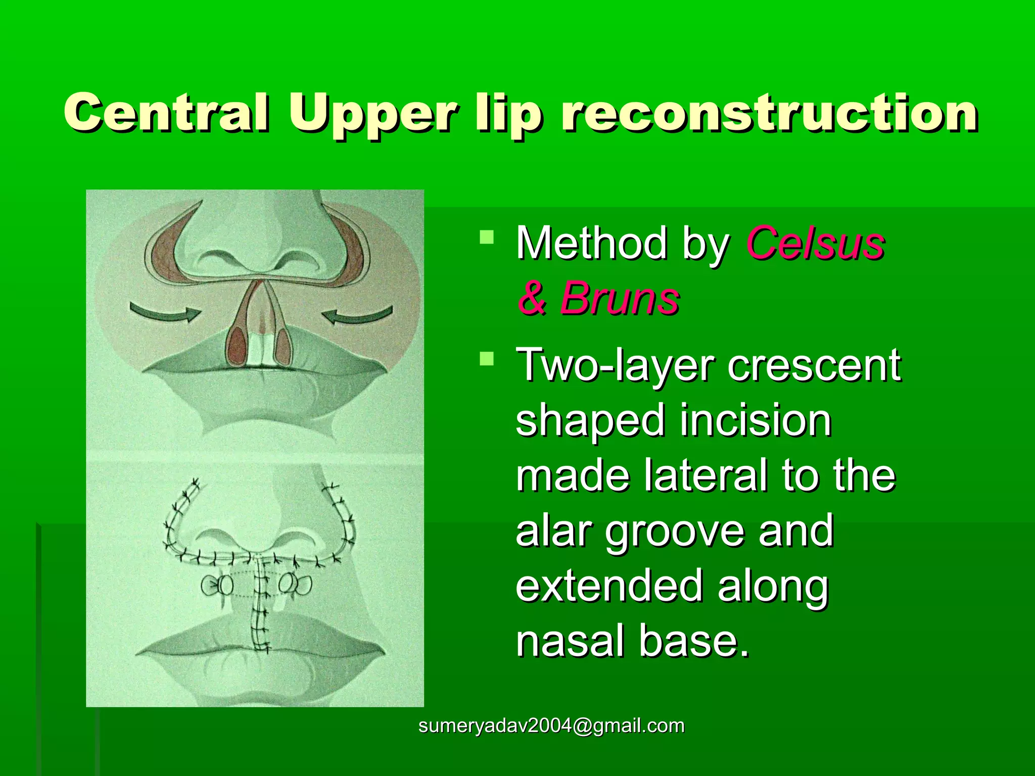 lip reconstruction | PPT