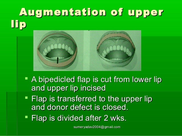 Lip Reconstruction