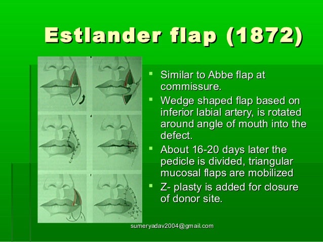 Estlander Flap Rotation And Transposition Flaps In Facial Plastic And