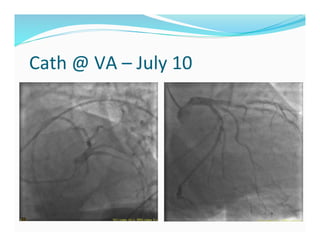 Cohen MG - AIMRADIAL 2013 - Complex PCI | PDF | Heart and Cardiovascular Diseases | Diseases and ...