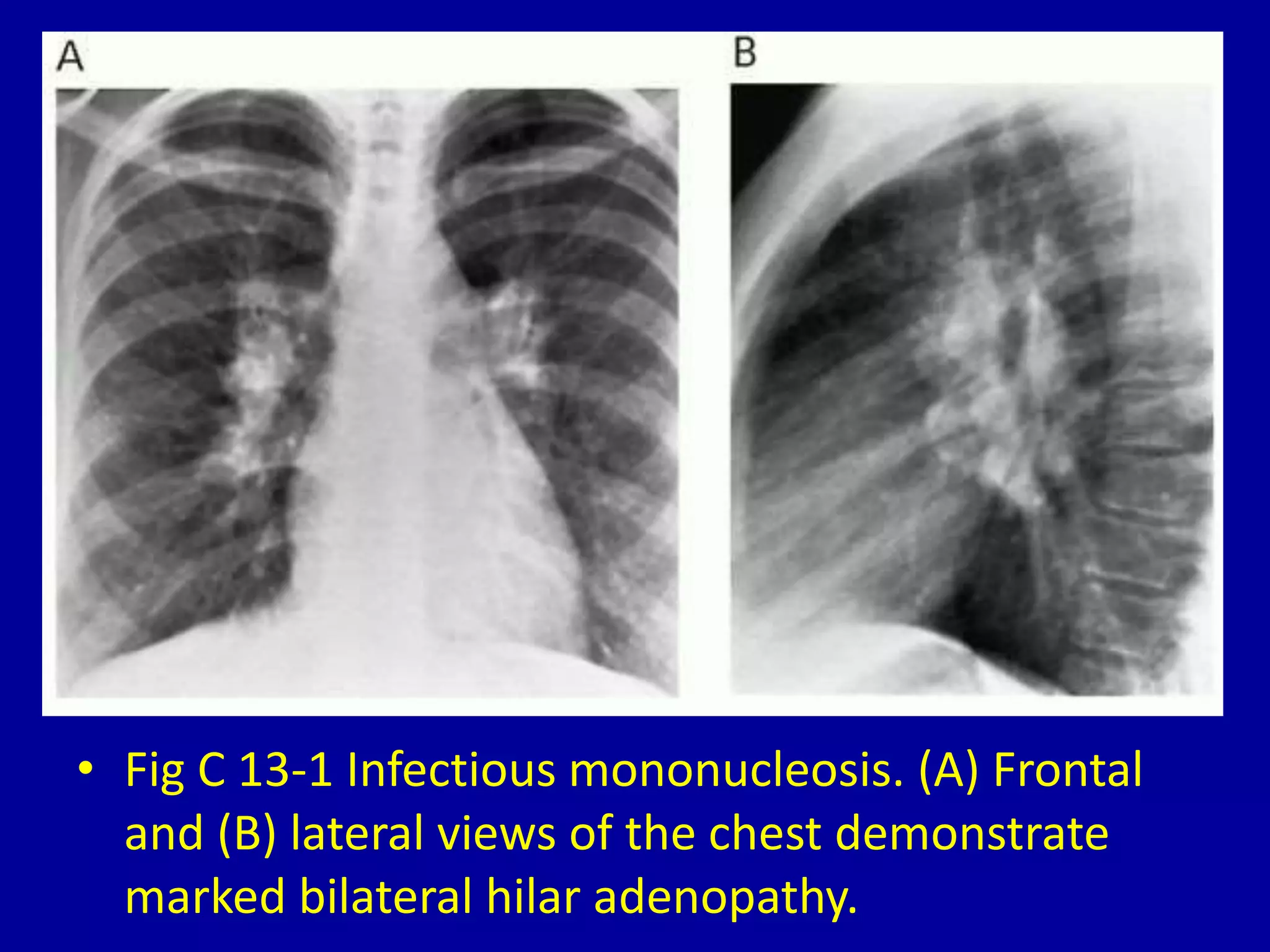 13 bilateral hilar enlargement | PPTX