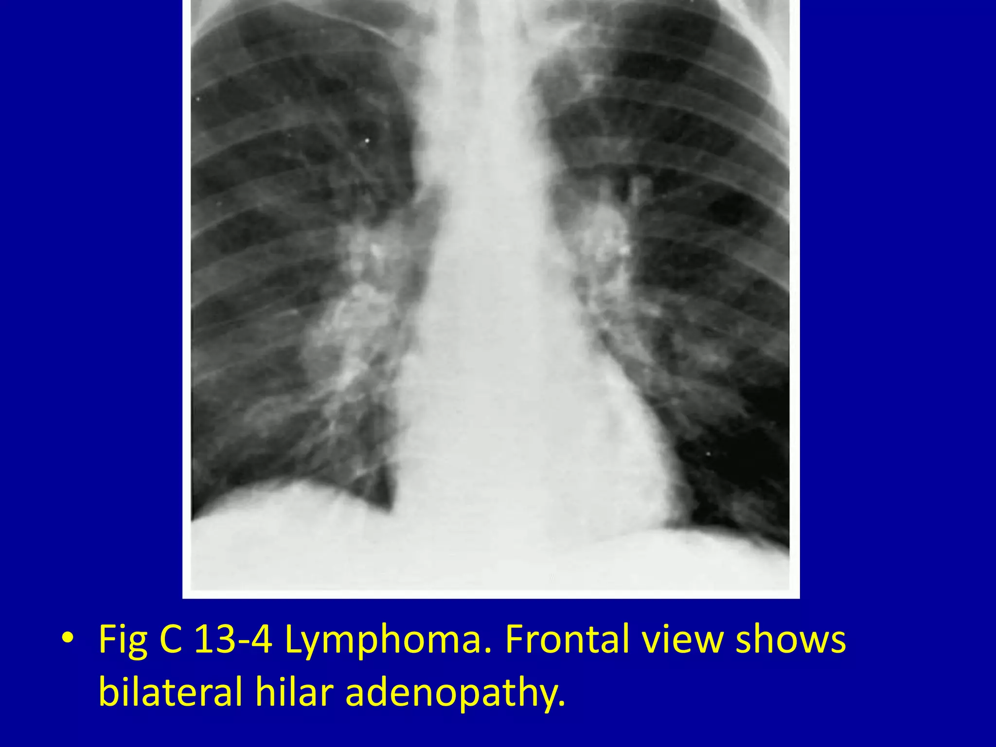 13 bilateral hilar enlargement | PPTX