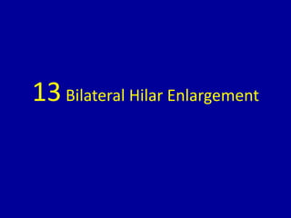 13 bilateral hilar enlargement | PPTX