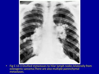 13 bilateral hilar enlargement | PPTX
