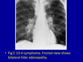 13 bilateral hilar enlargement | PPTX