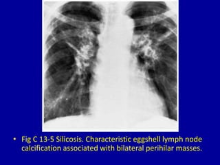 13 bilateral hilar enlargement | PPTX