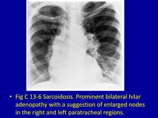13 bilateral hilar enlargement | PPTX