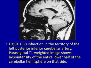 13 cerebellar masses on magnetic resonance imaging | PPTX