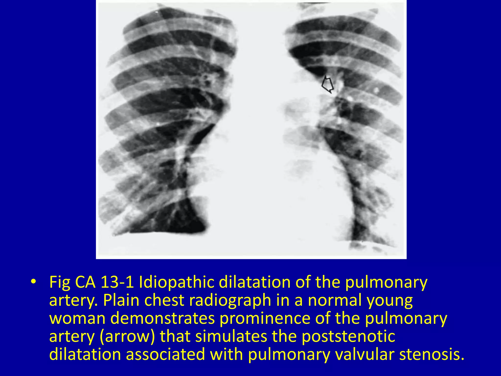 13 dilatation of the main pulmonary artery | PPTX