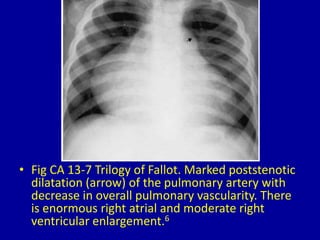 13 dilatation of the main pulmonary artery | PPT