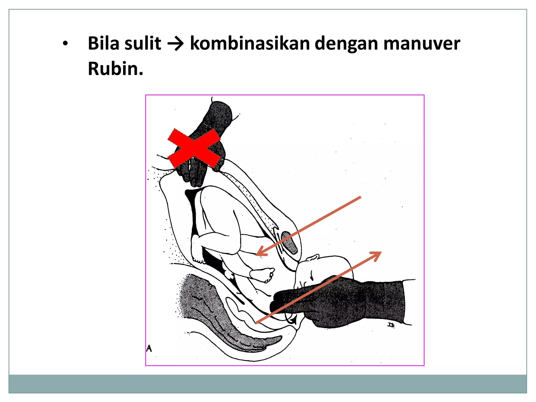 Distosia Bahu final | PDF