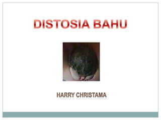 Distosia Bahu final | PDF
