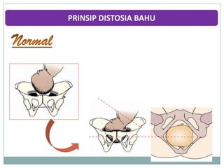 Distosia Bahu final | PDF