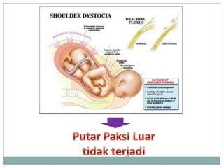 Distosia Bahu final | PDF