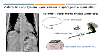 Devices in the Management of Chronic Heart Failure | PPTX