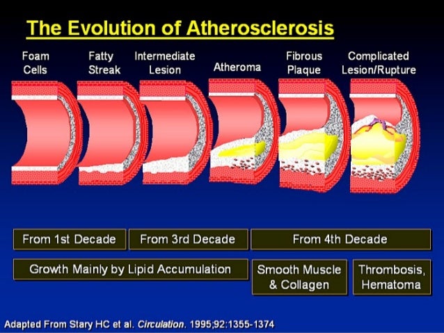 Acute Coronary Syndrome