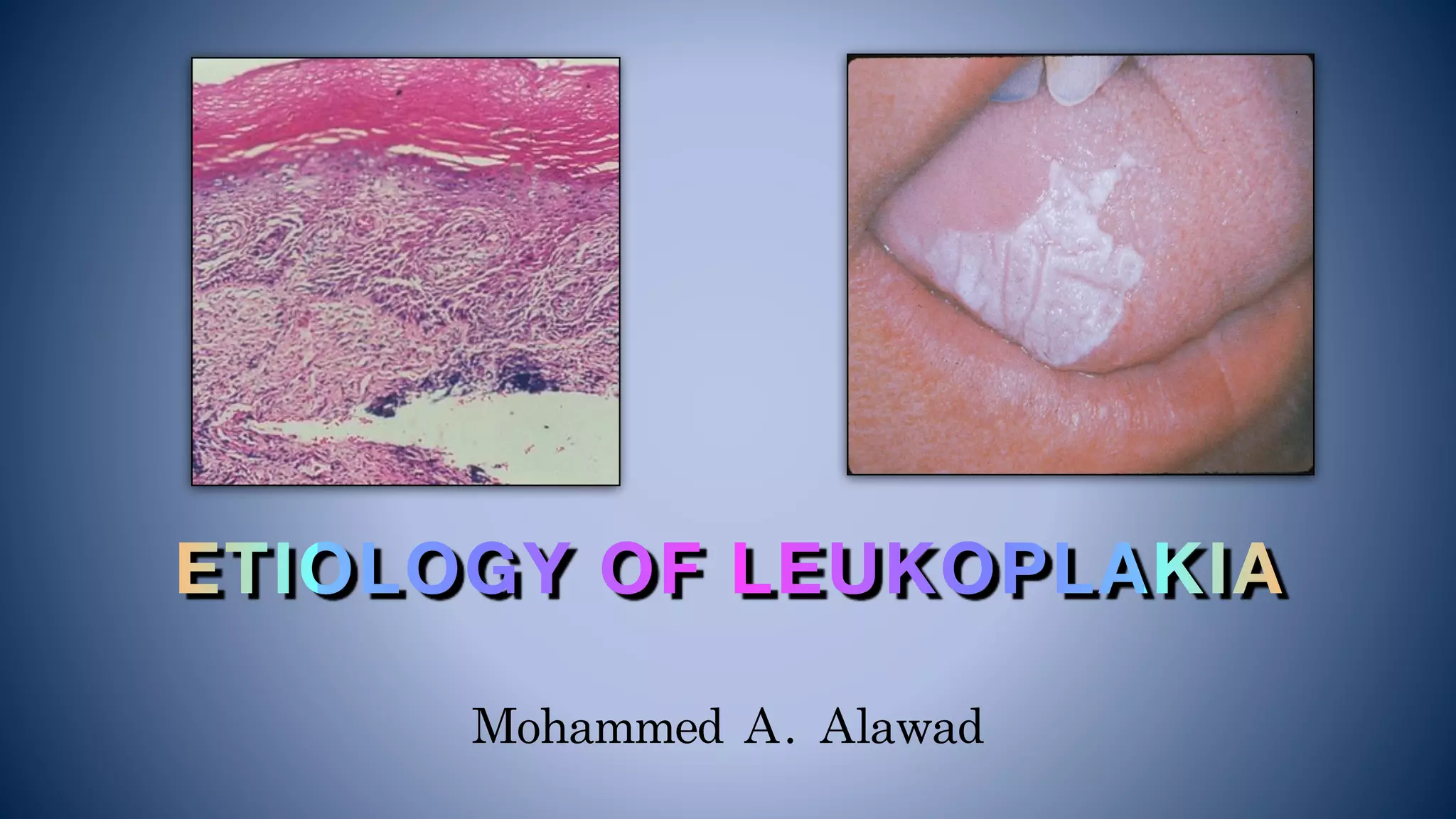 Etiology of Leukoplakia | PDF