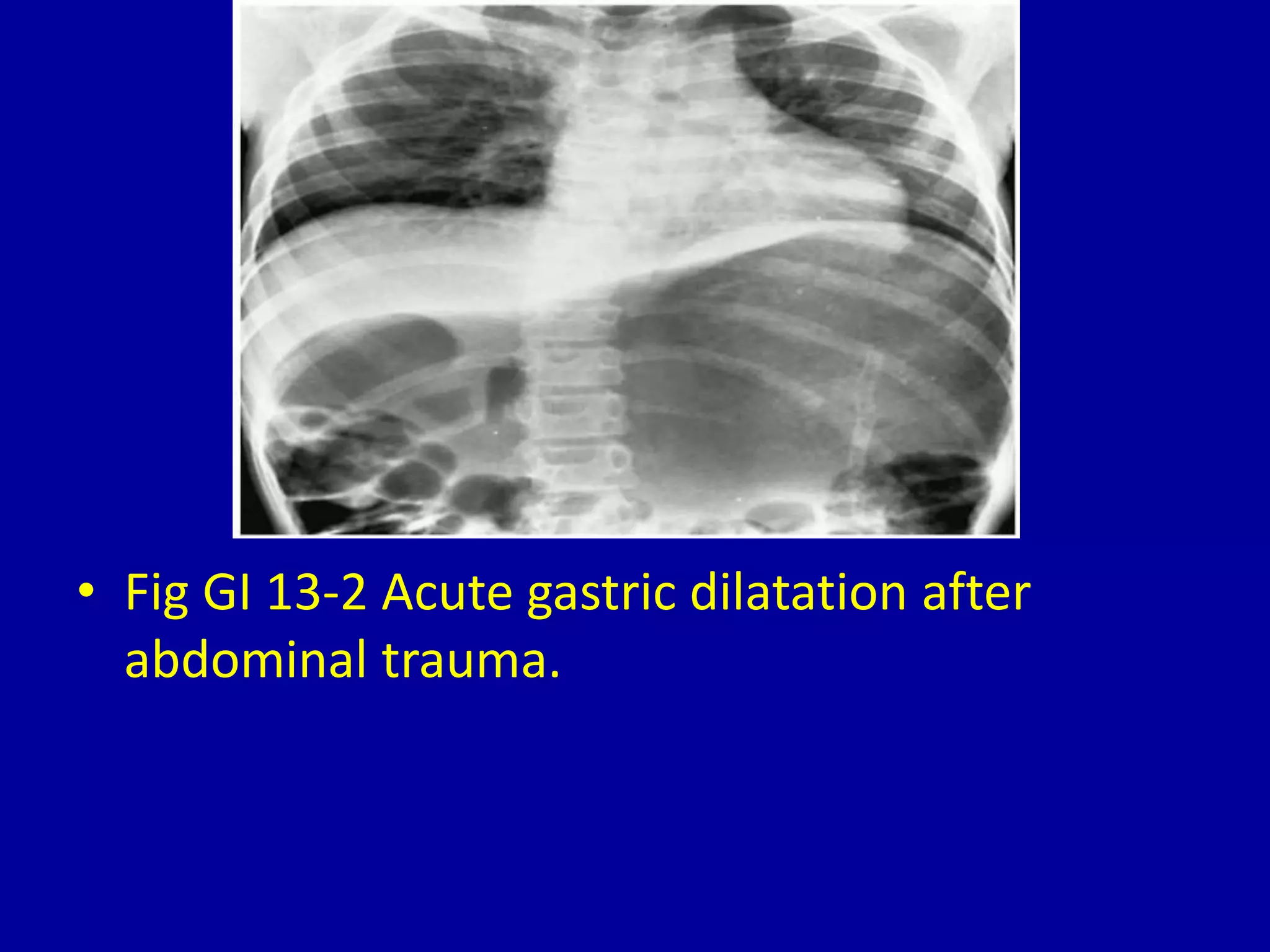 13 gastric dilatation without outlet obstruction | PPTX