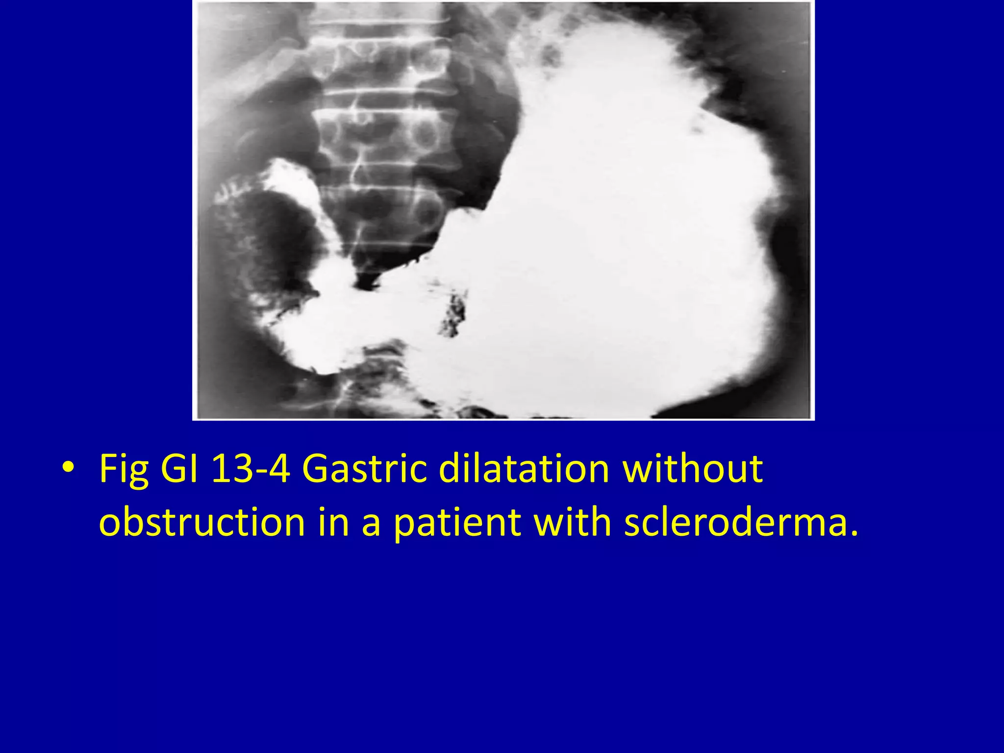 13 gastric dilatation without outlet obstruction | PPTX