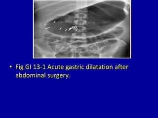 13 gastric dilatation without outlet obstruction | PPTX