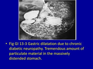 13 gastric dilatation without outlet obstruction | PPTX