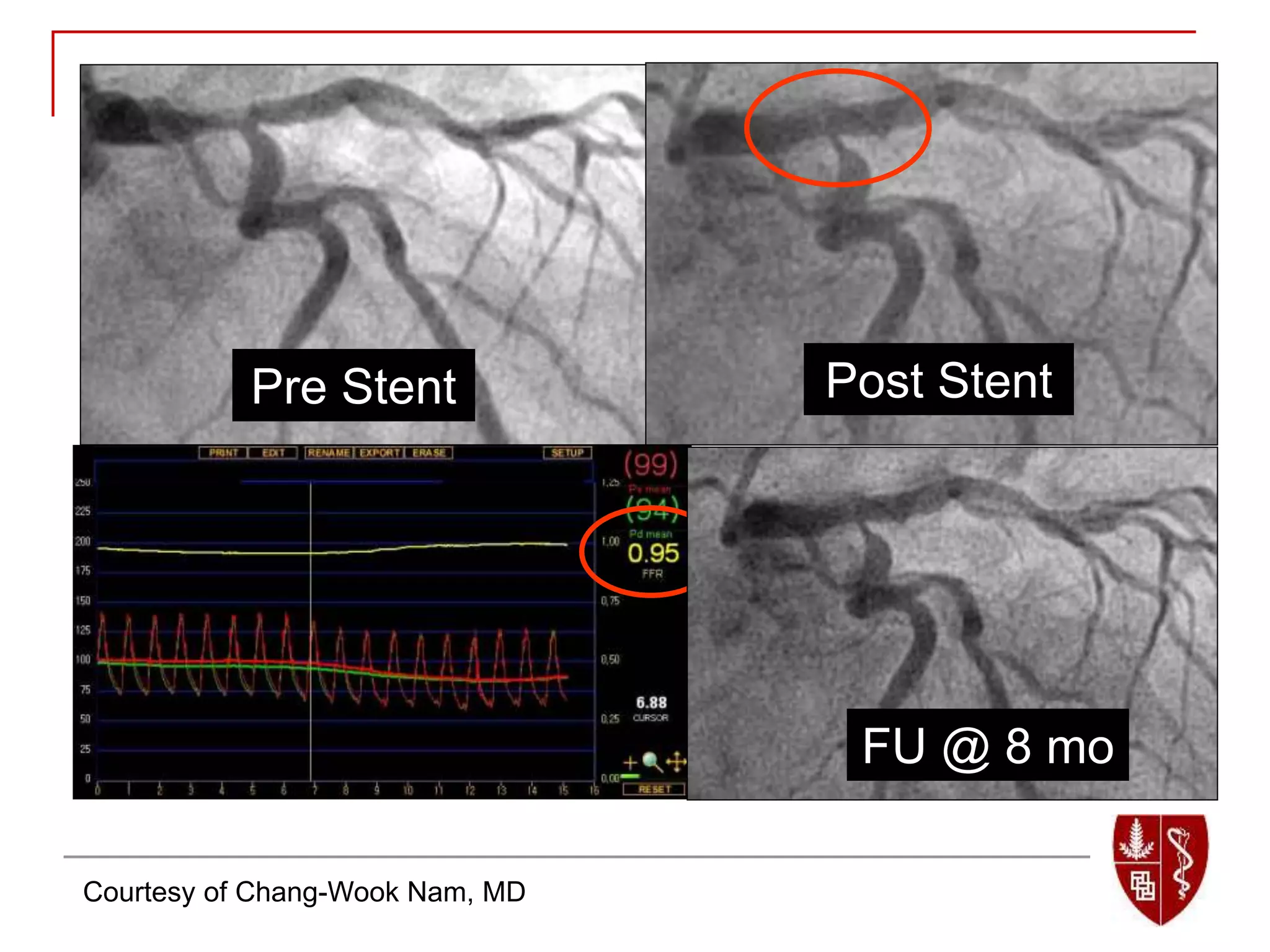 PCI & AimRadial 2018 | FFR in Left Main Disease - William F. Fearon | PPT