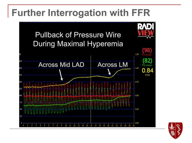 PCI & AimRadial 2018 | FFR in Left Main Disease - William F. Fearon | PPT