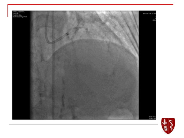 PCI & AimRadial 2018 | FFR in Left Main Disease - William F. Fearon | PPT