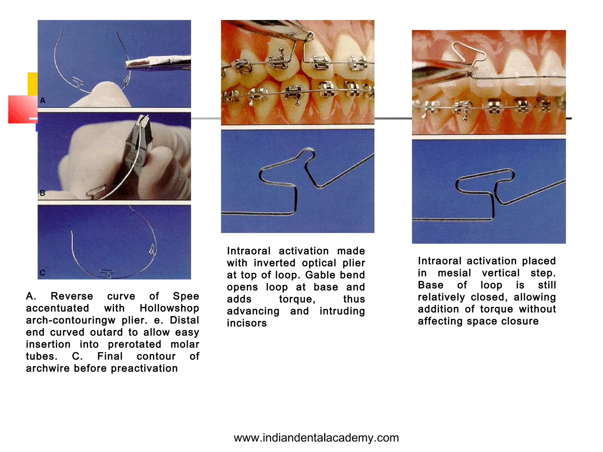 Multifunctional Archwire For Bite Opening Certified Fixed Orthodontic