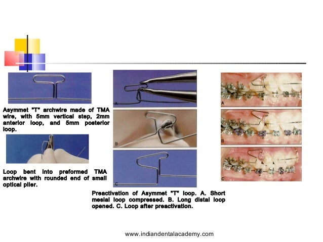 13 Multifunctional Archwire For Bite Opening Torque